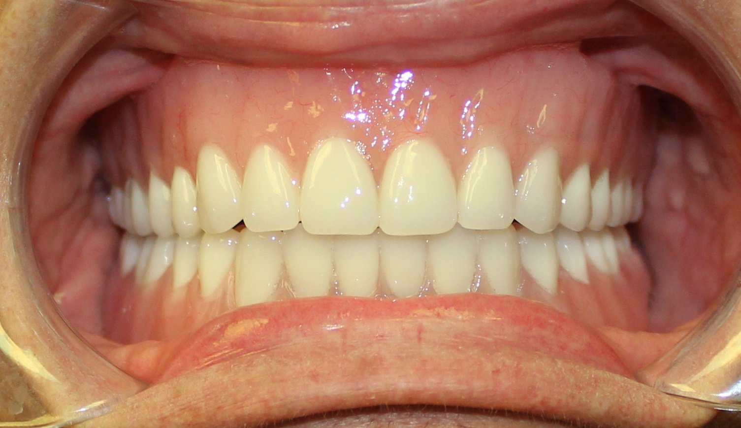 Missing Upper & Lower Teeth Fixed Mentor OH | Dentures on Implants Photos